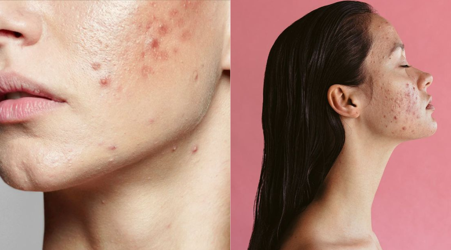 Purging dan Breakout: Apa Bedanya?